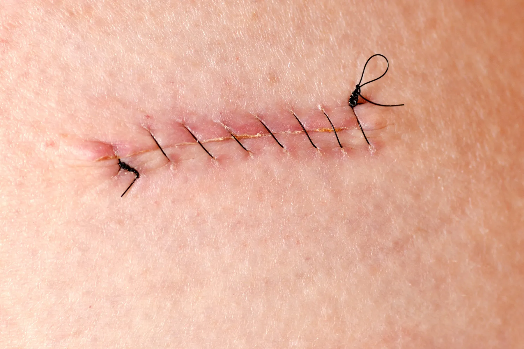 how does stitching a wound work