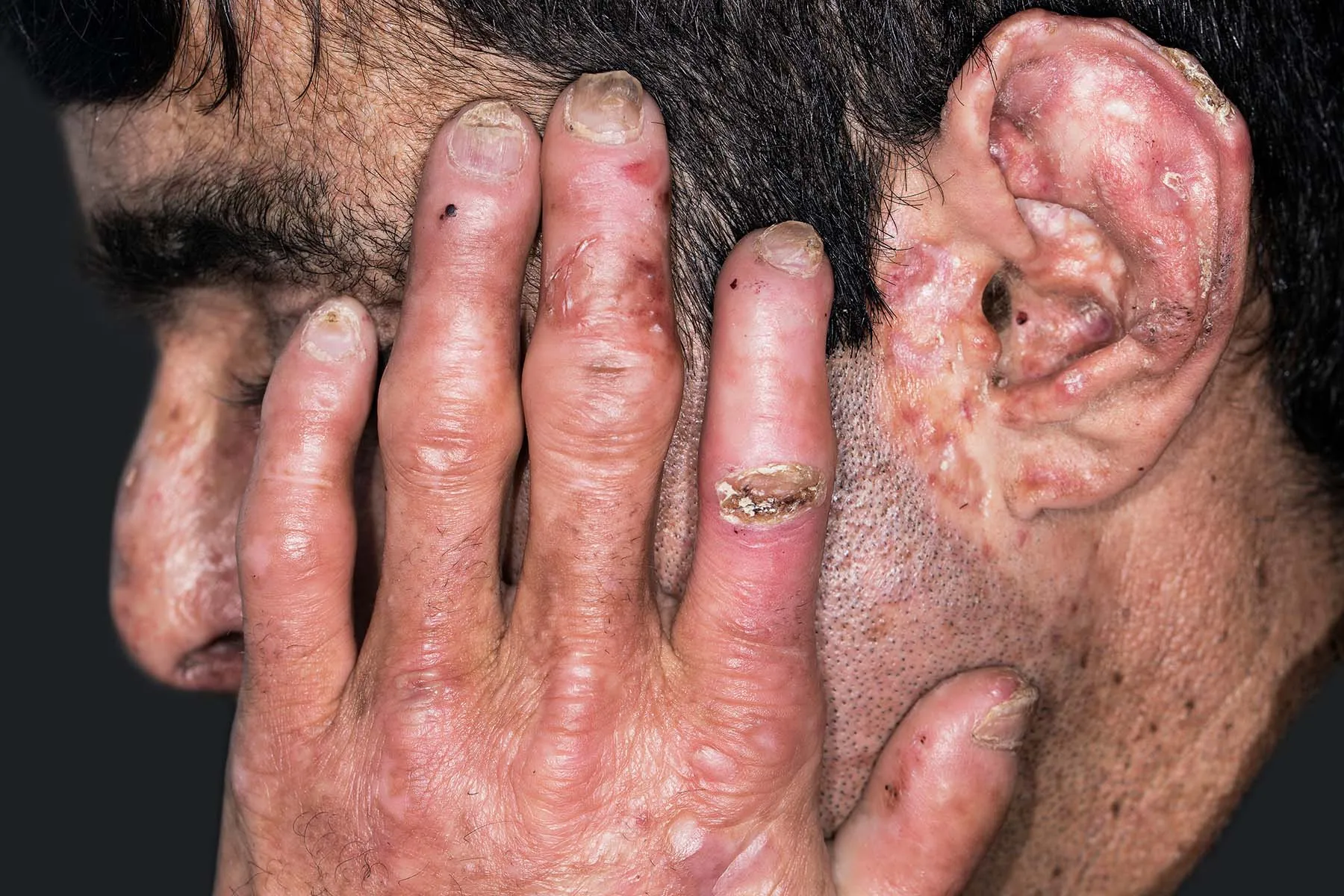 porphyria sharp teeth