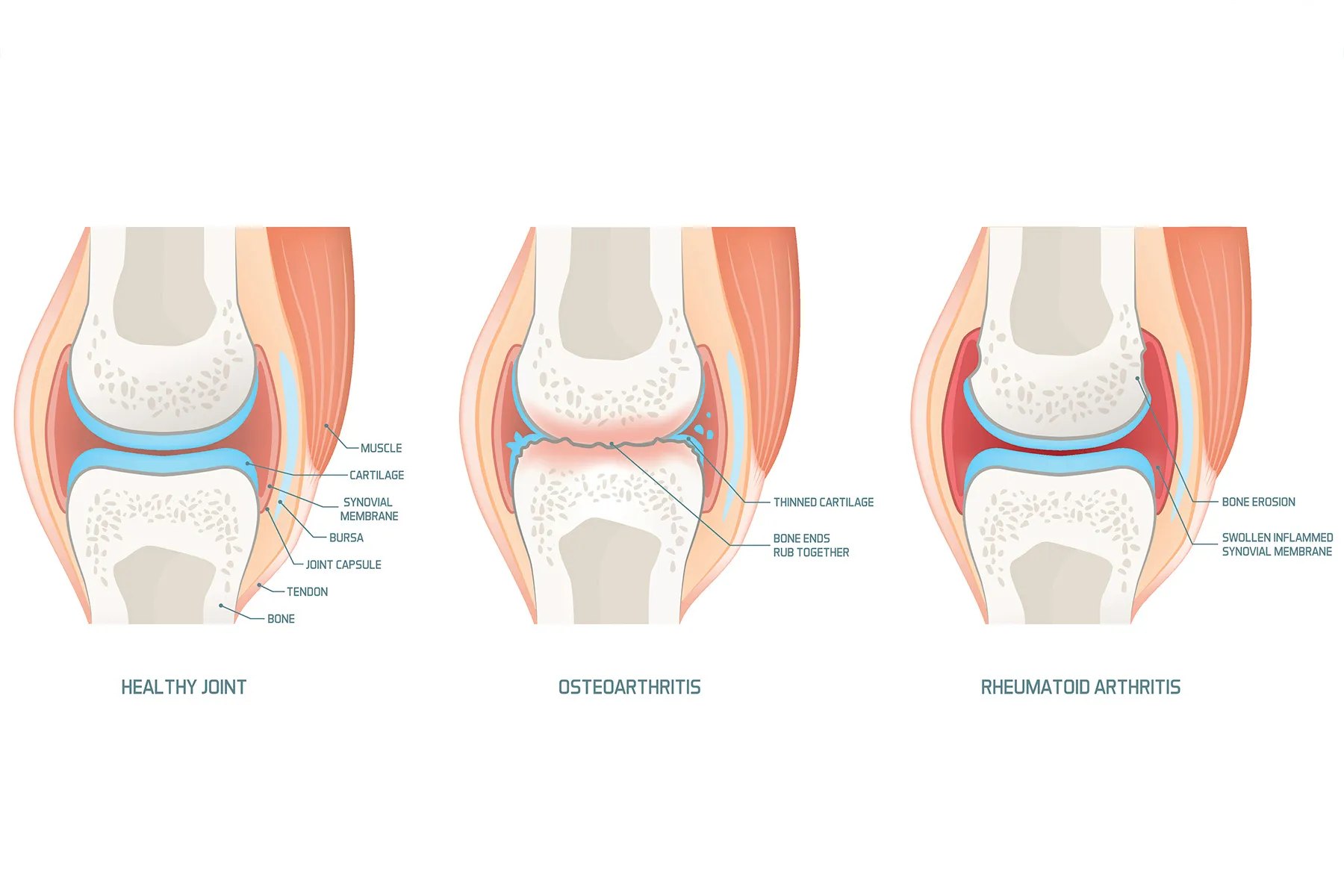 Rheumatoid Arthritis vs Osteoarthritis: What's the Difference?