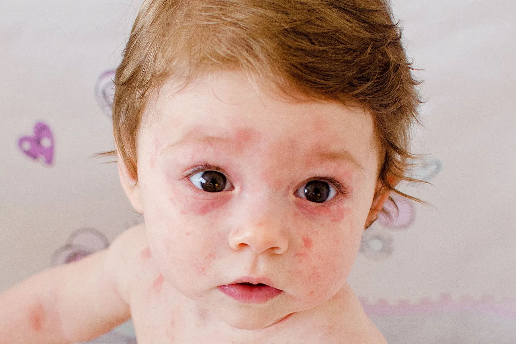 Roseola Face