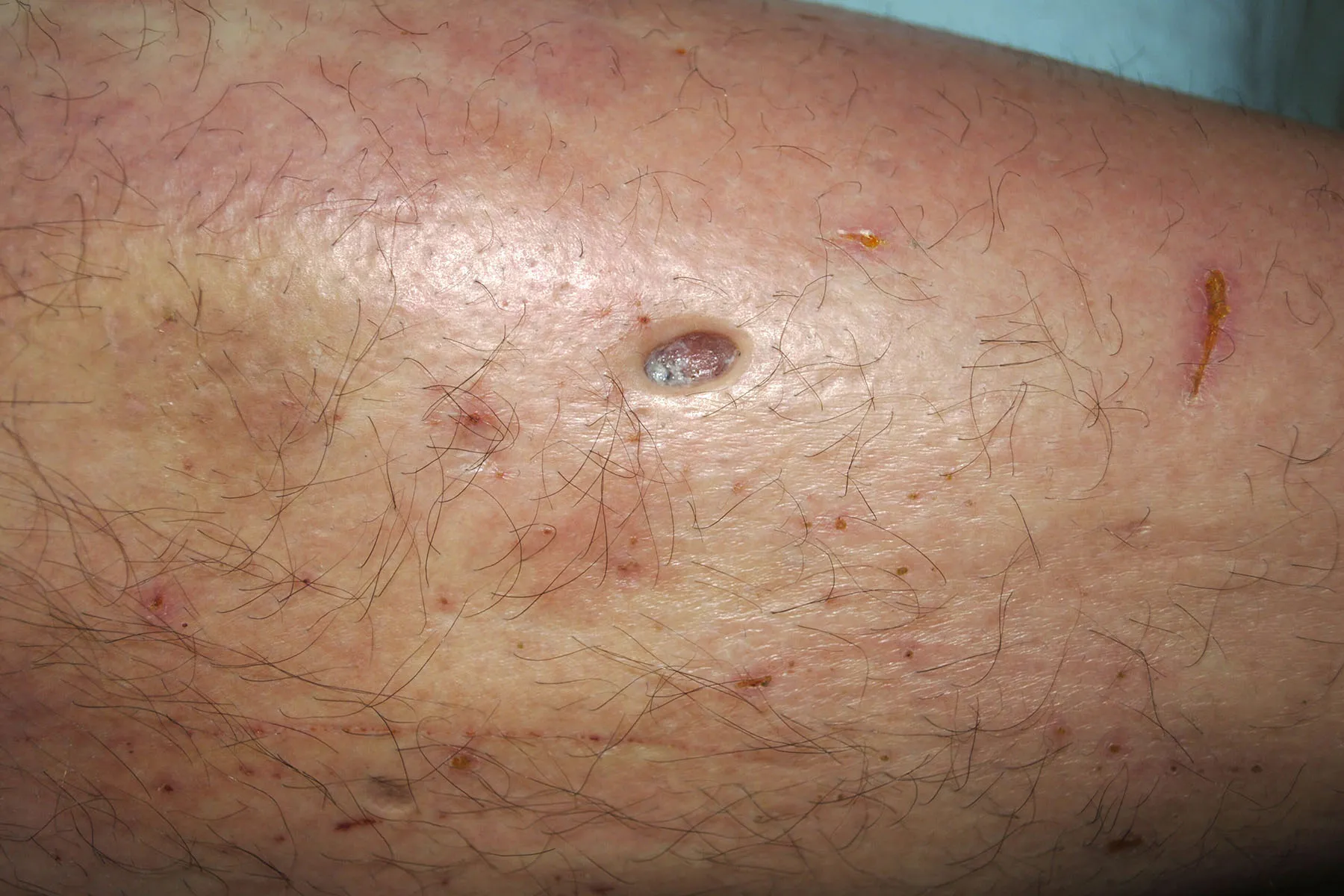 Skin Abrasion On Face