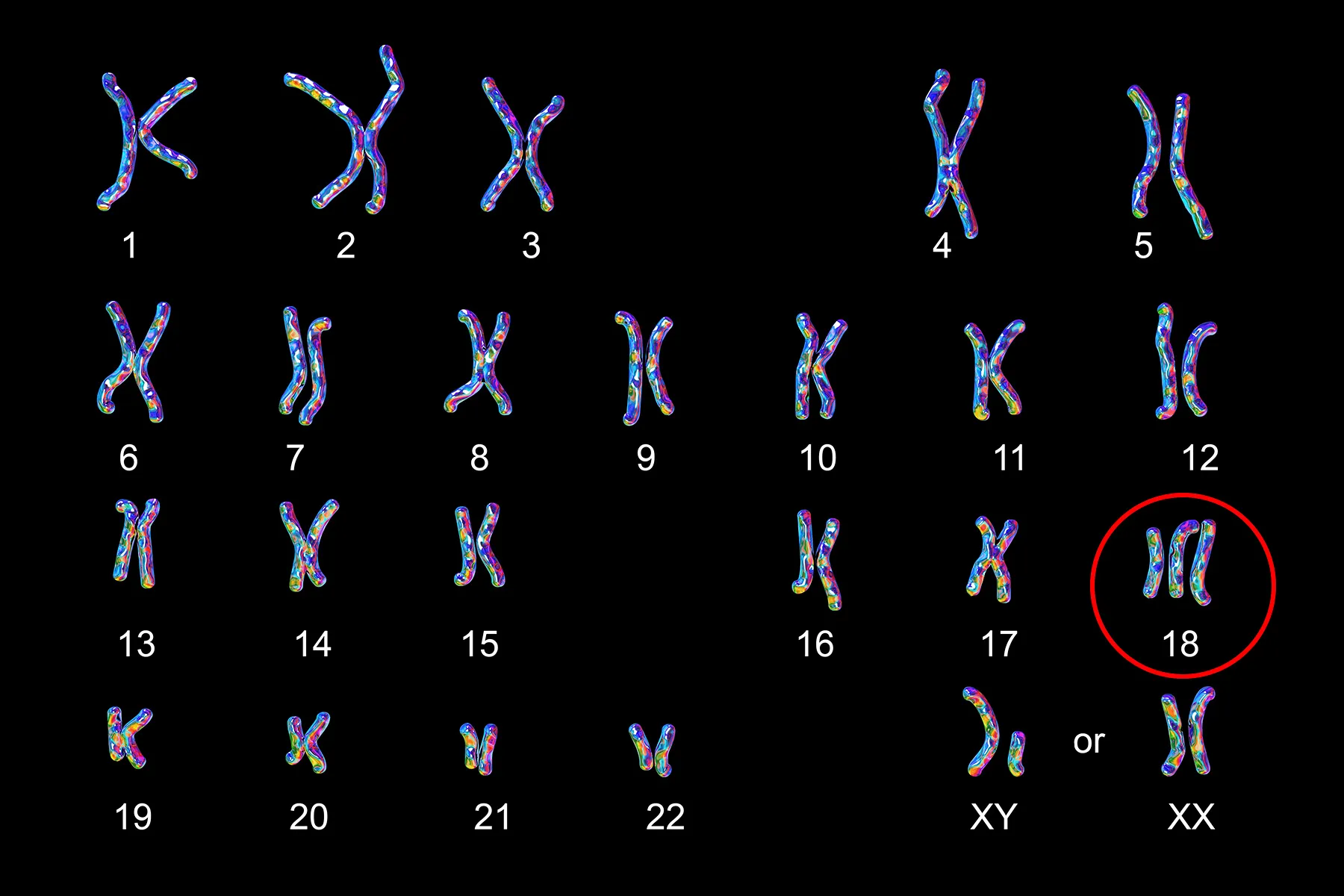 Trisomy 18 (Edwards Syndrome): Symptoms, Causes, Diagnosis
