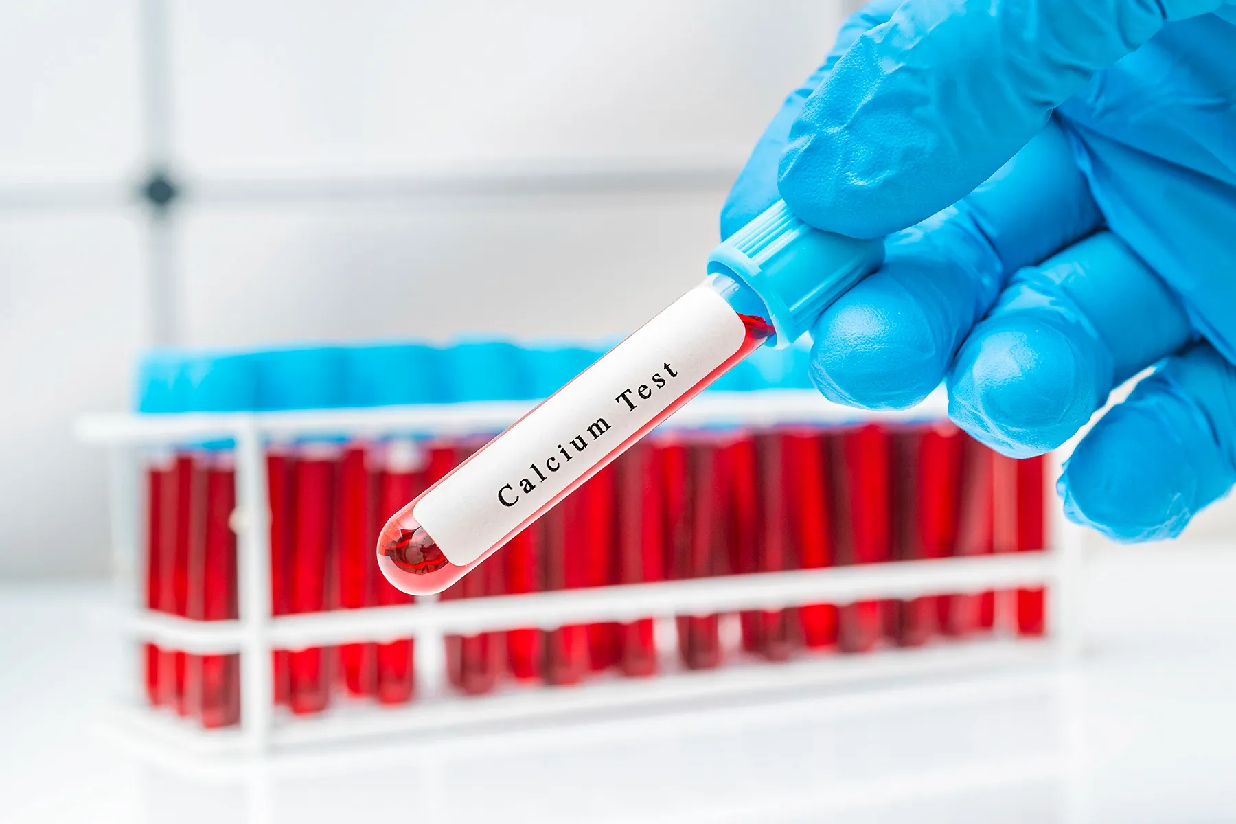 Hypocalcemia: Symptoms, Causes, and Treatments