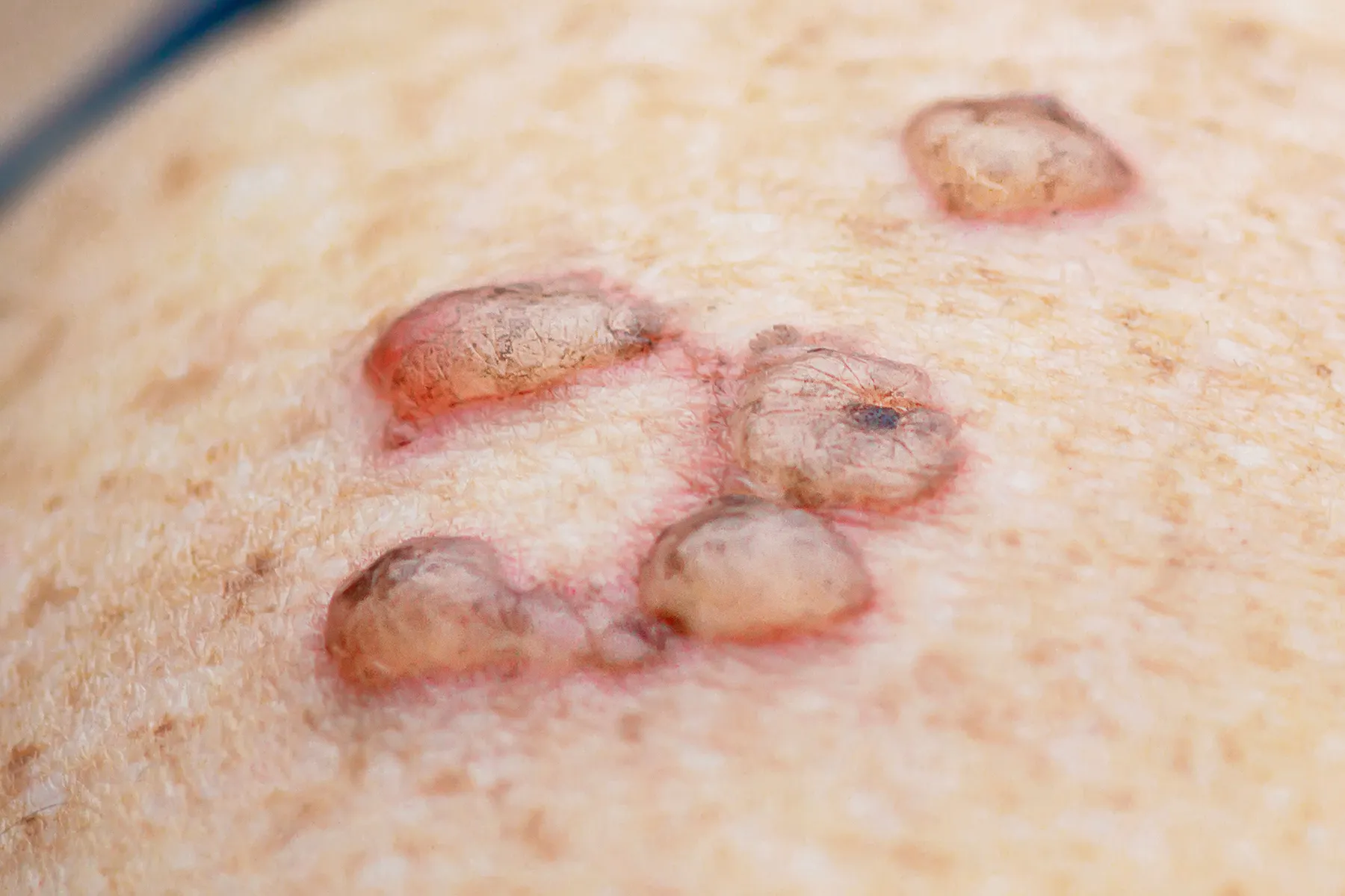 Chancroid: What Is It and How Does It Impact My Health?