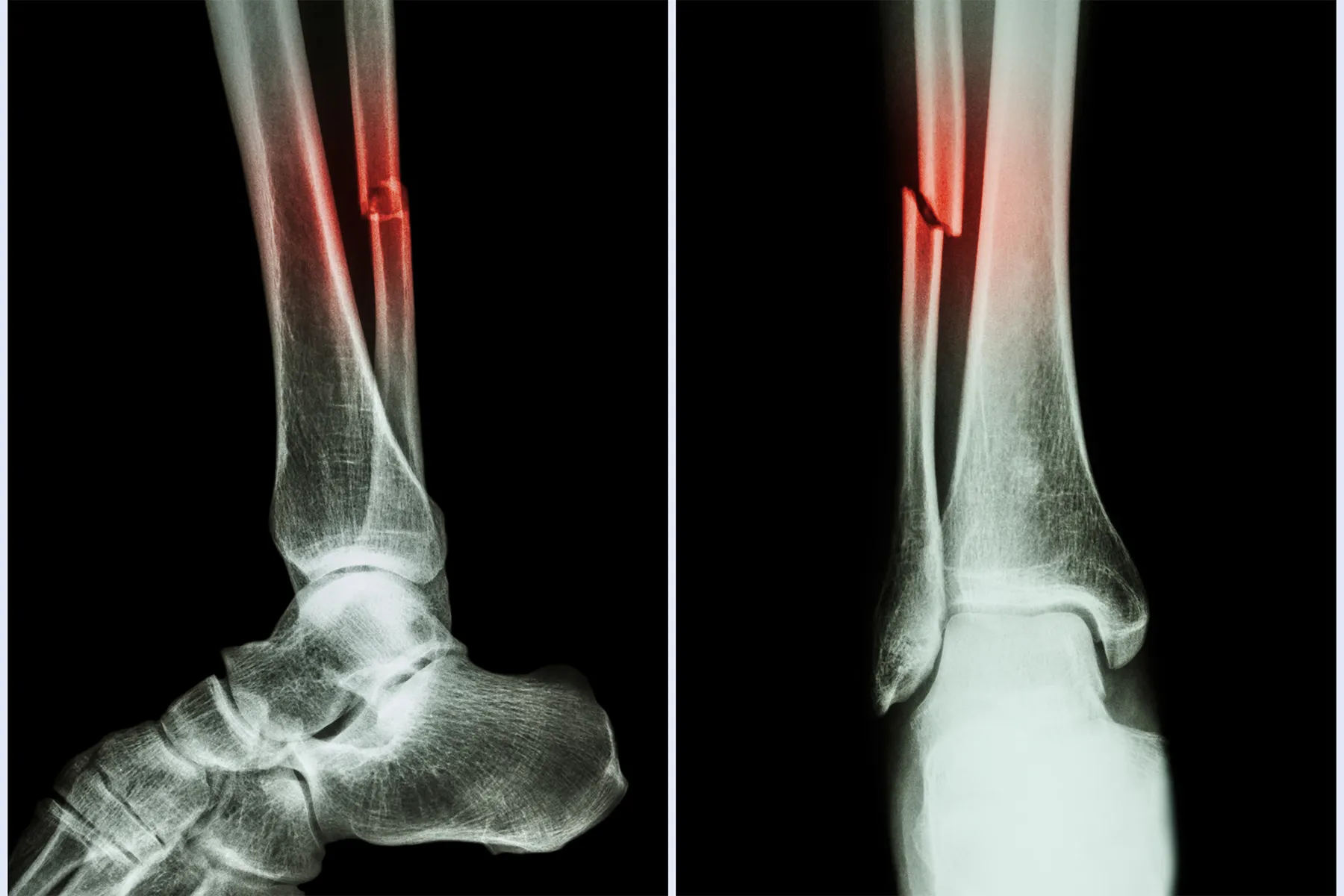 Fractured Fibula X Ray