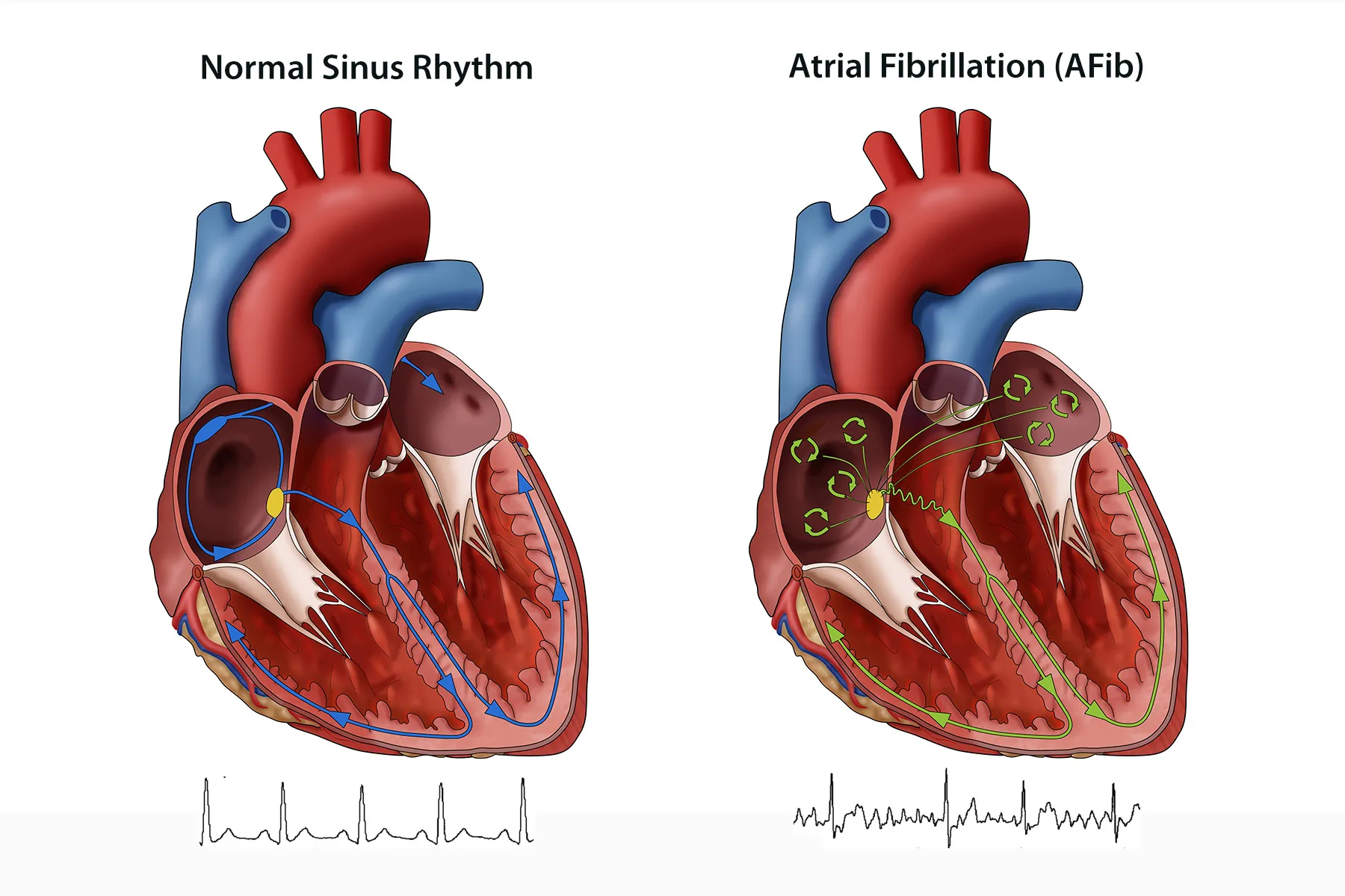 Maze Procedure (Surgical Ablation) for Atrial Fibrillation (AFib)