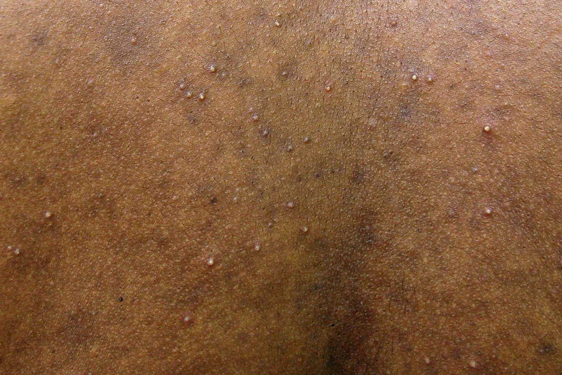 Pityrosporum (Malassezia) Folliculitis: Causes, Symptoms, and Treatment