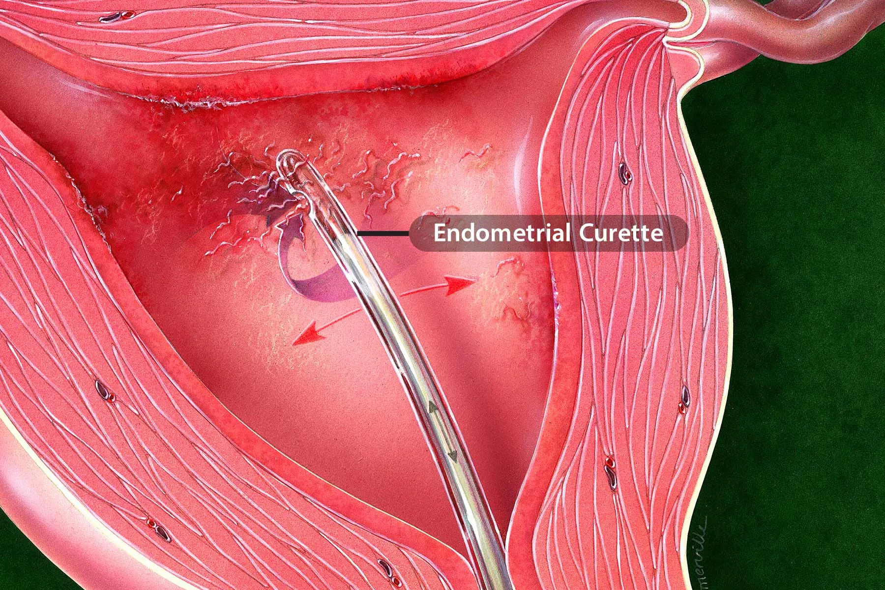 Biopsi Endometriale N Tiran Spitali Continental