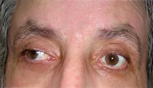 Exophoria Symptoms, Diagnosis, Treatment