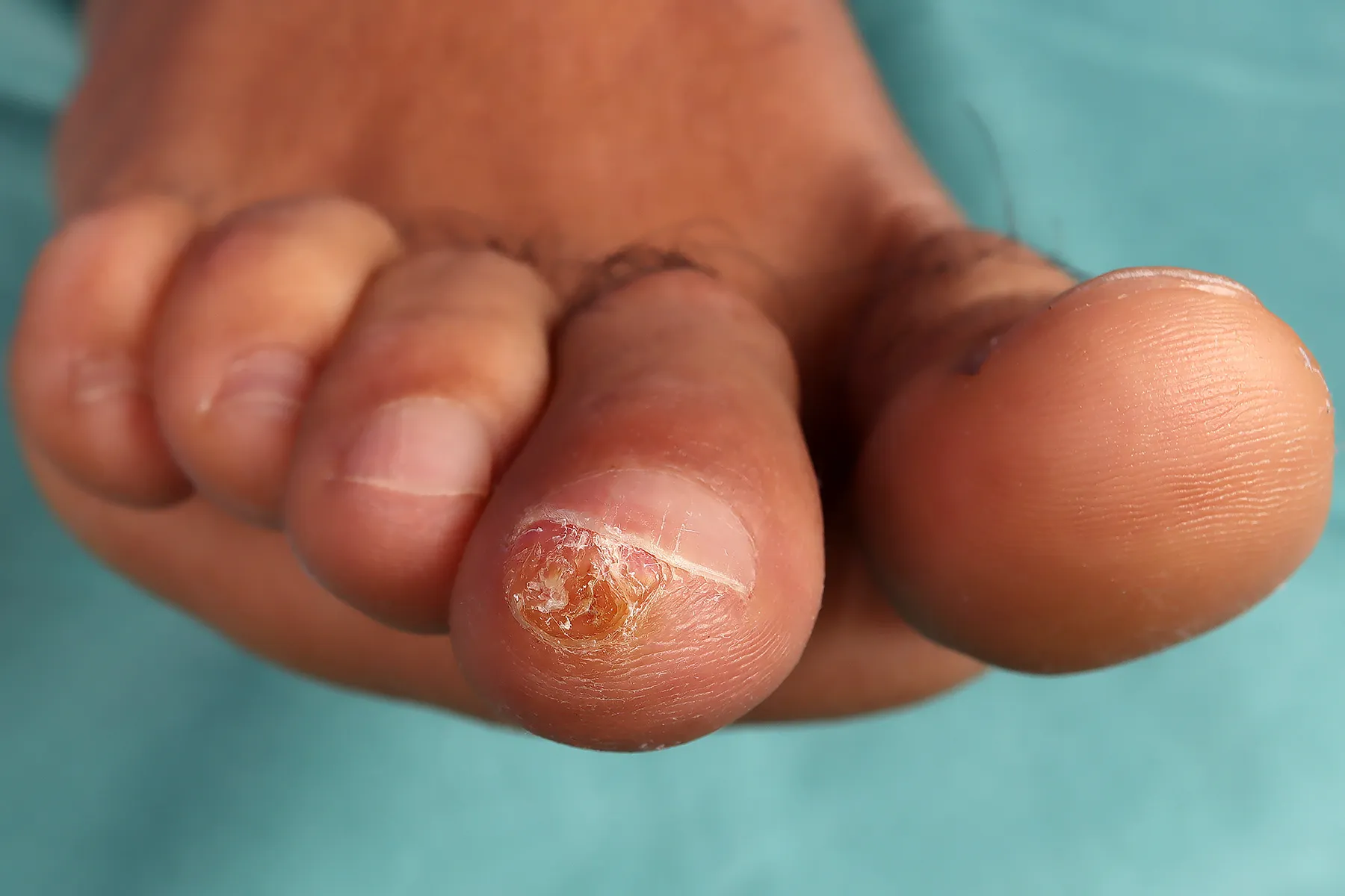 Exostosis: Causes, Treatments, Complications, and More