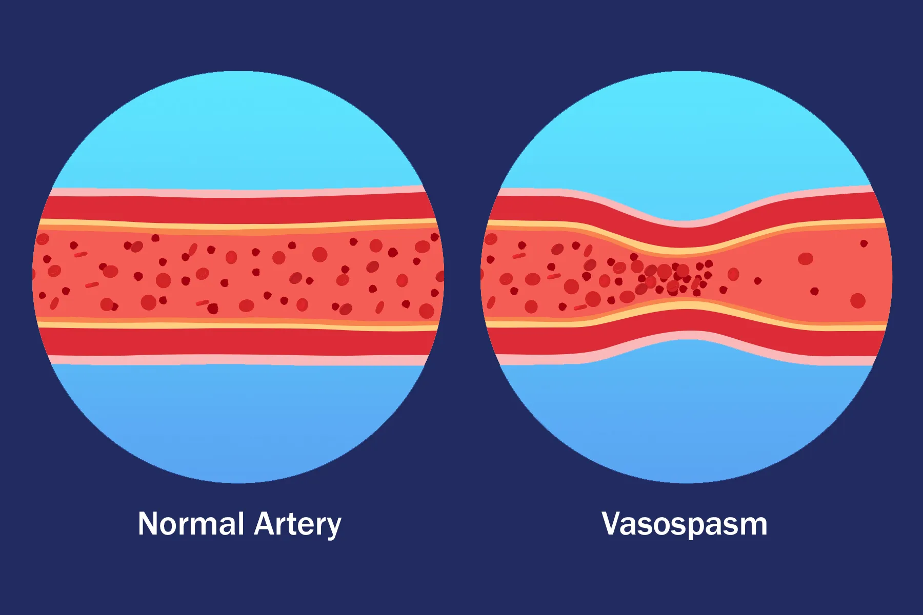 Vasospasm: Causes, Symptoms & Treatment for Brain and Heart
