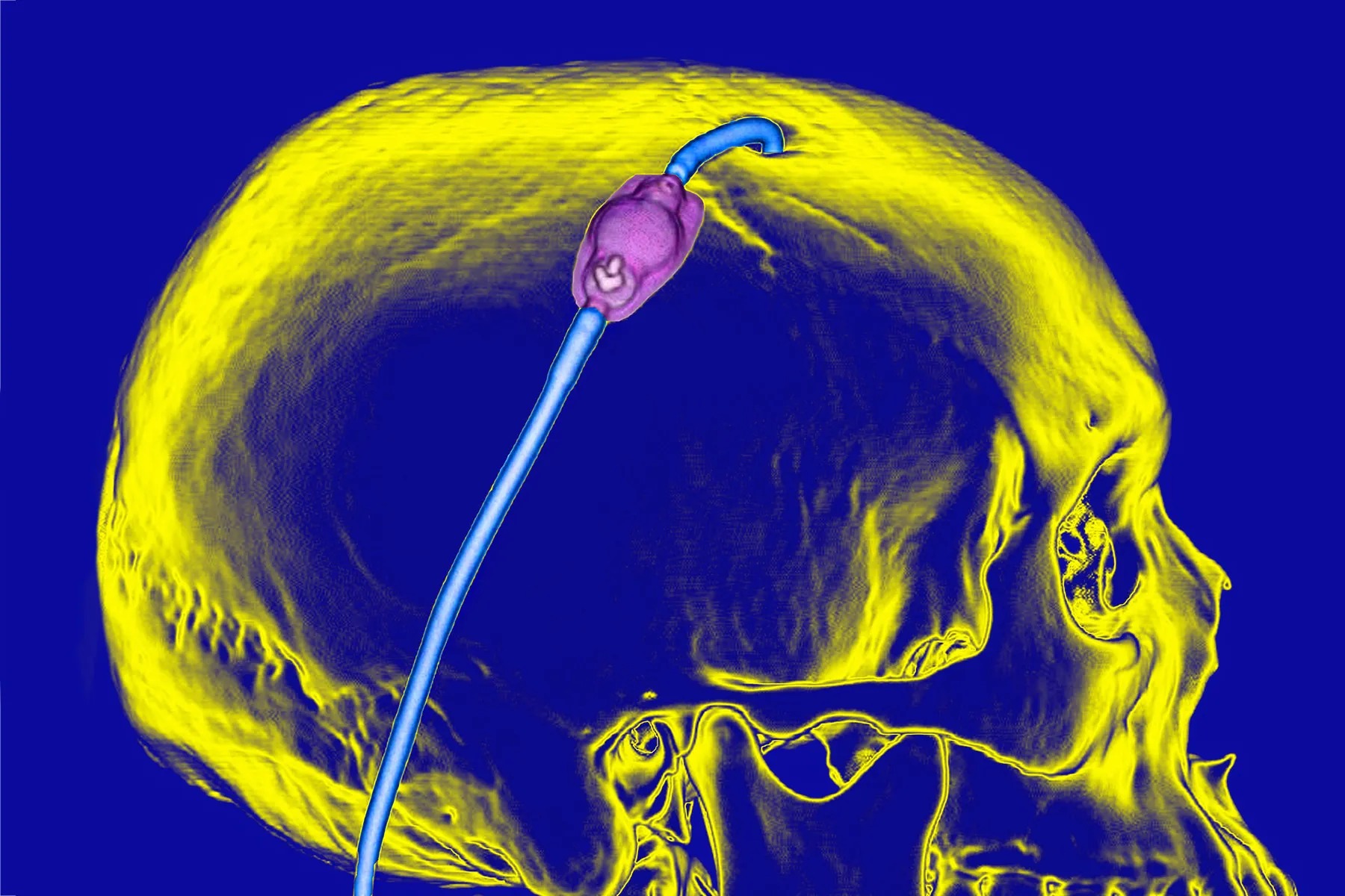 How Does A Ventriculoperitoneal Shunt Work