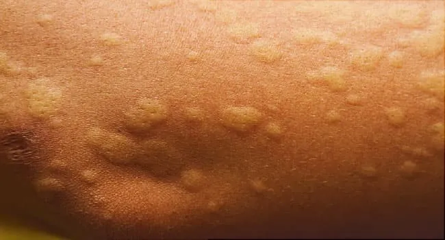 chronic cutaneous