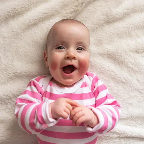 WebMD Eczema Guide: Locations on the Body