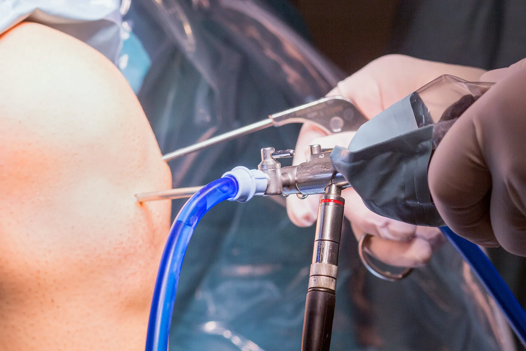 bilateral arthroscopy