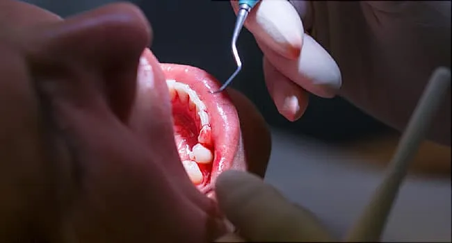 why is bleeding from mouth