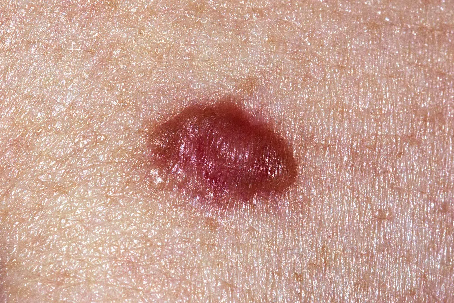 Basal Cell Carcinoma: Causes, Symptoms, and Treatment Options