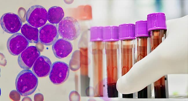 Chronic Myelogenous Leukemia (CML): Causes, Symptoms, Treatment