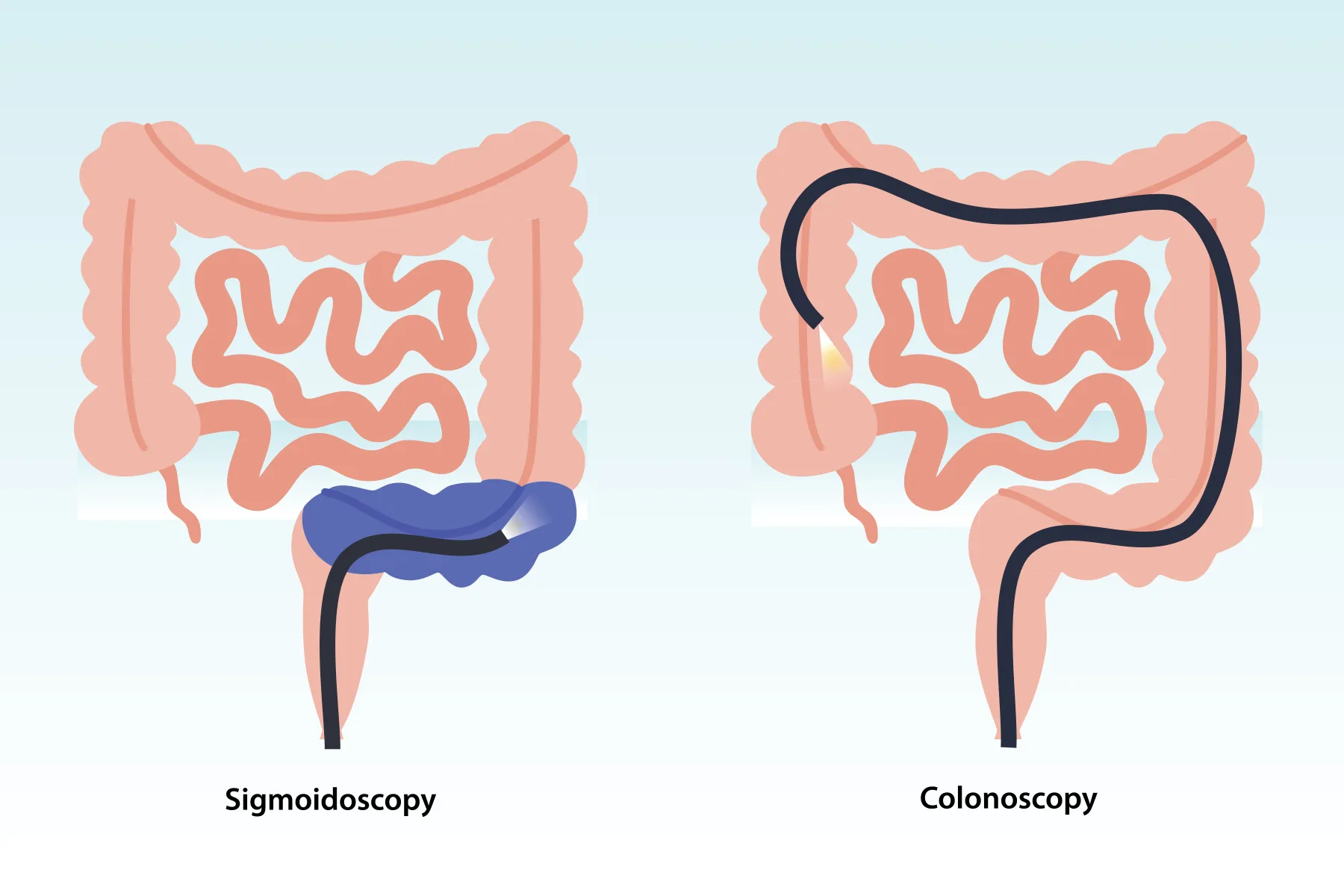 Colonoscopy vs. Sigmoidoscopy
