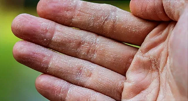 atopic dermatitis hyperlinear palms