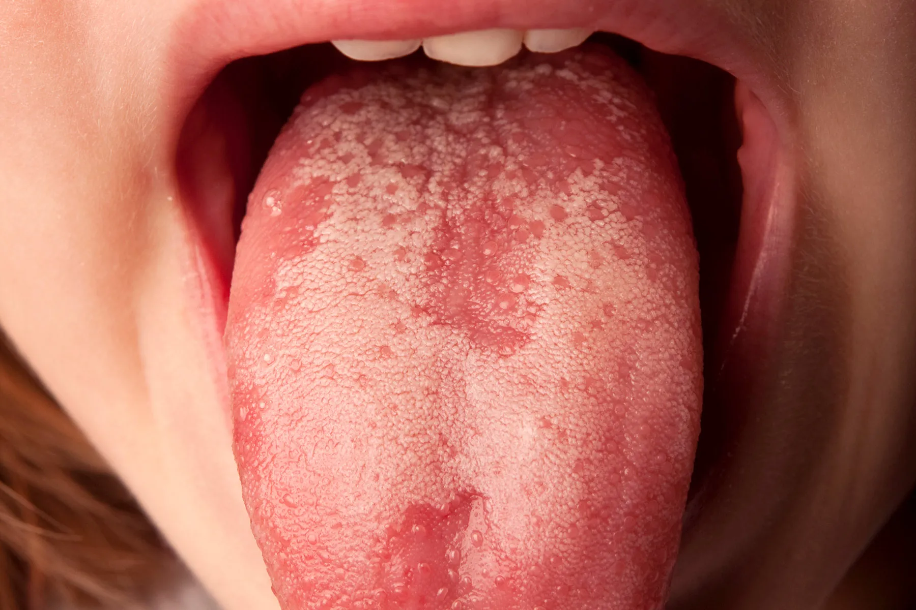 split tongue condition