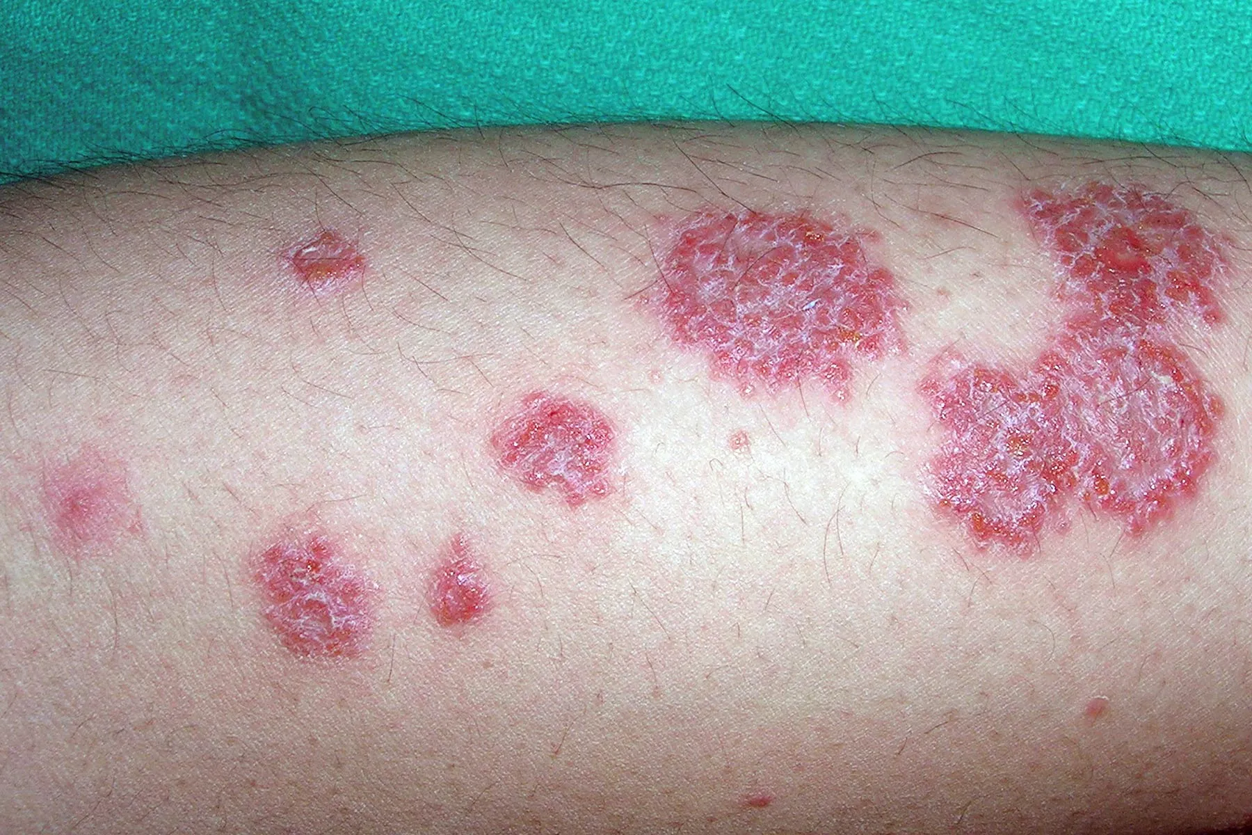 What Is Nummular Eczema?