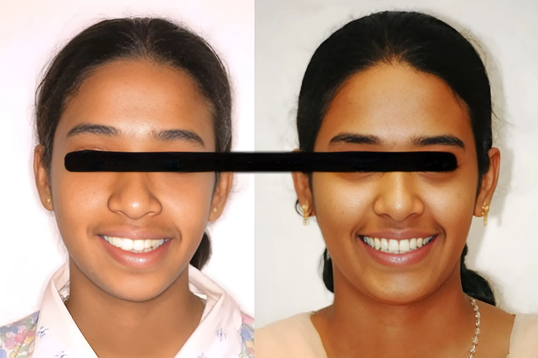 What Is Orthognathic Surgery?