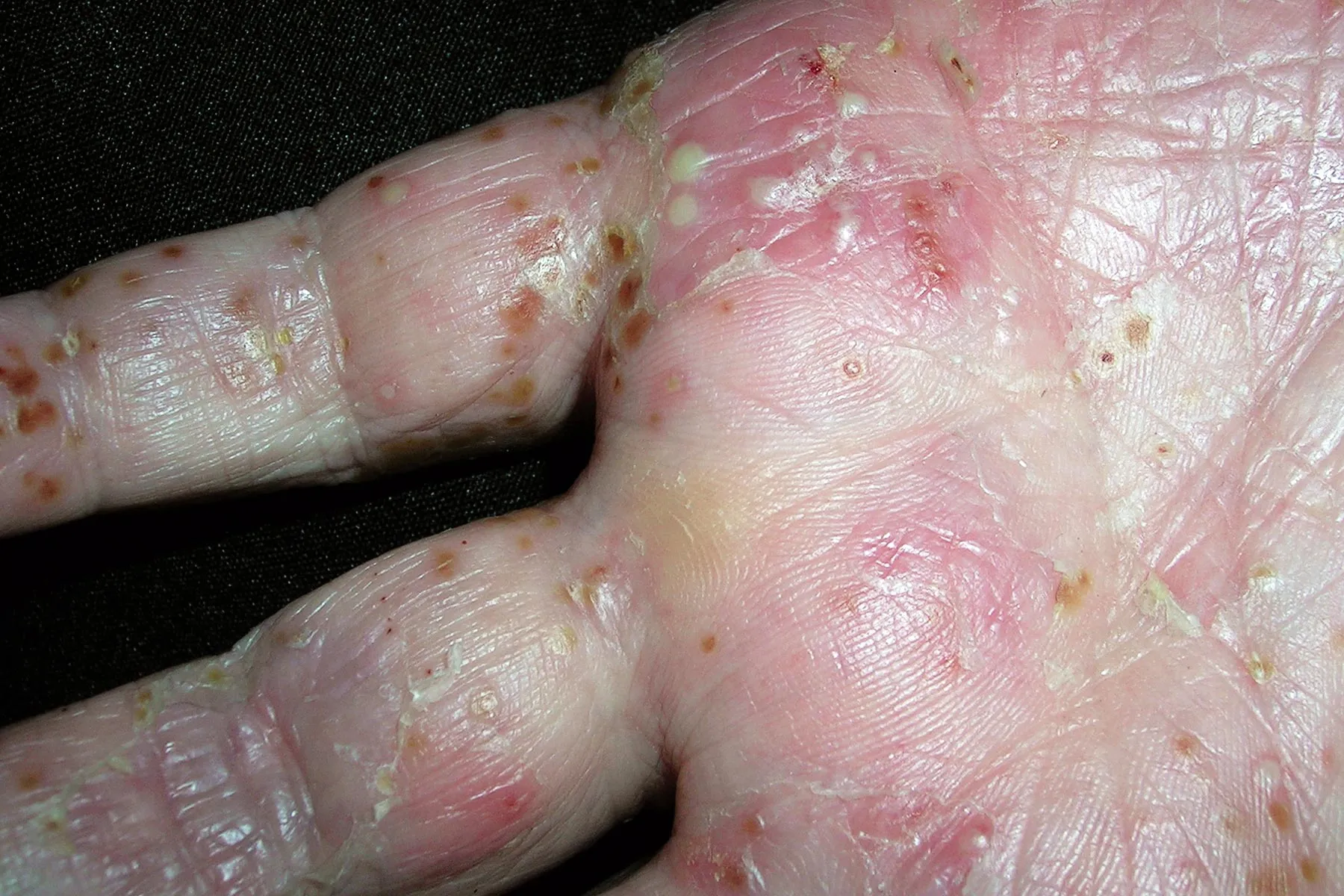 Palmoplantar Pustulosis on Hands and Feet: Symptoms, Causes, Treatment