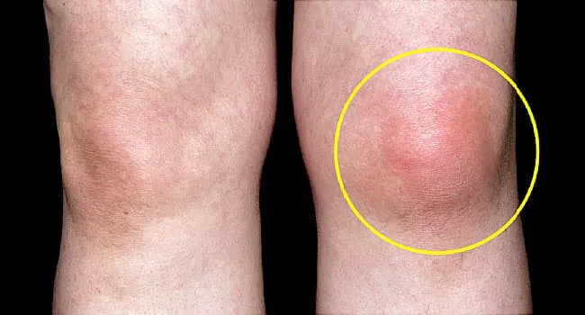 gout knee cap