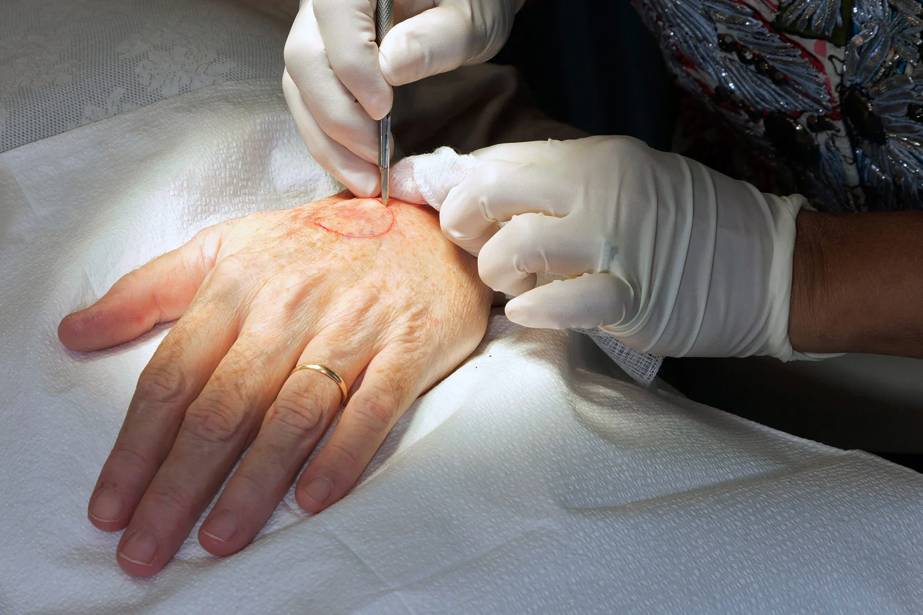 Treatment Options for Advanced Basal Cell Carcinoma