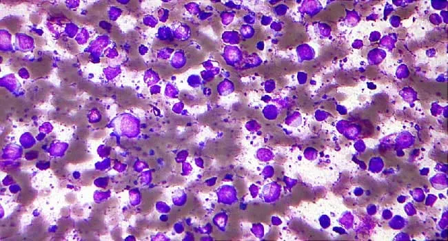 What Is B-Cell Lymphoma?