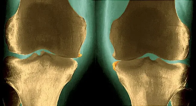 knee replacement xray normal