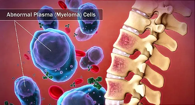Visual Guide to Multiple Myeloma