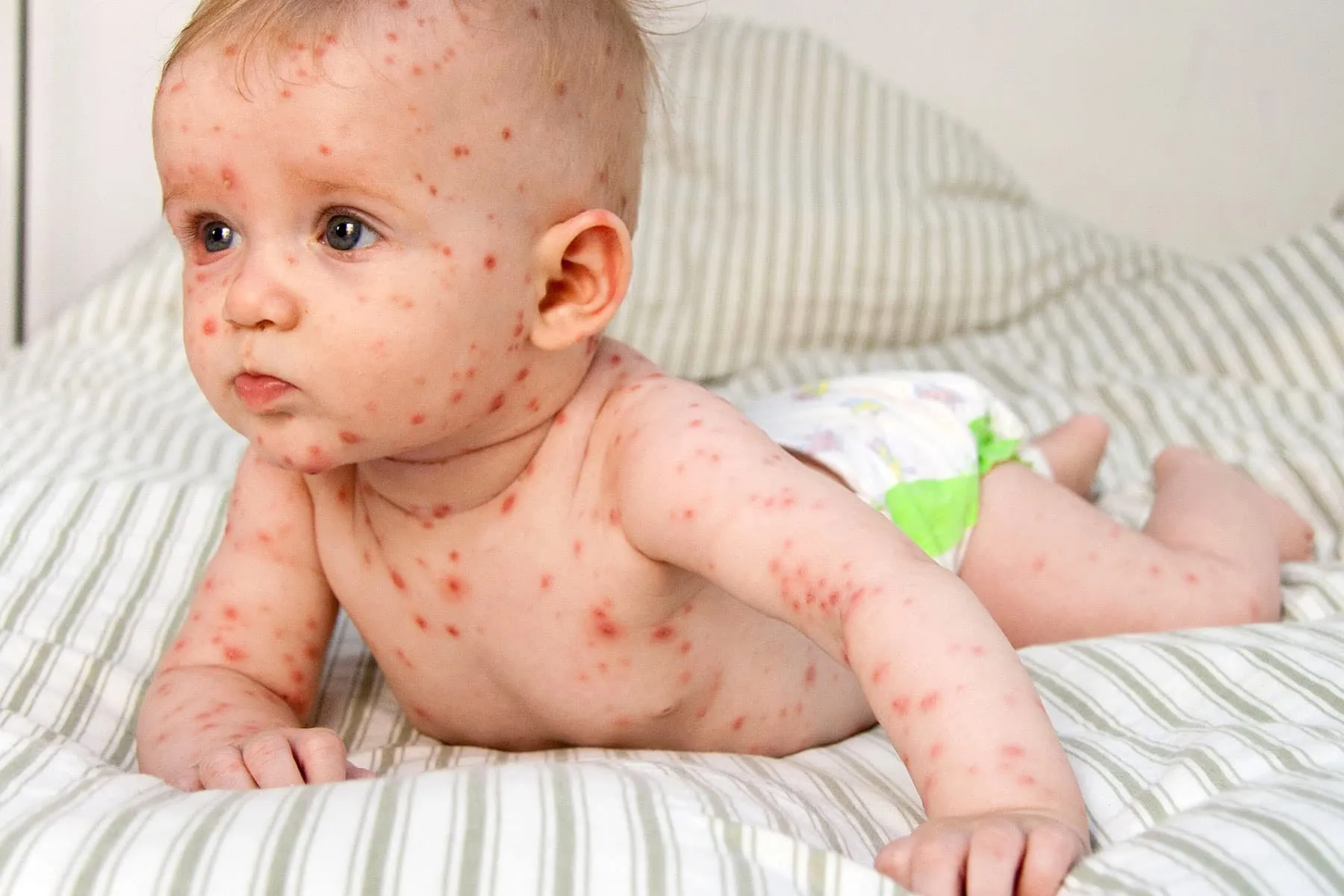 What Does A Viral Rash Look Like On A Baby Infoupdate
