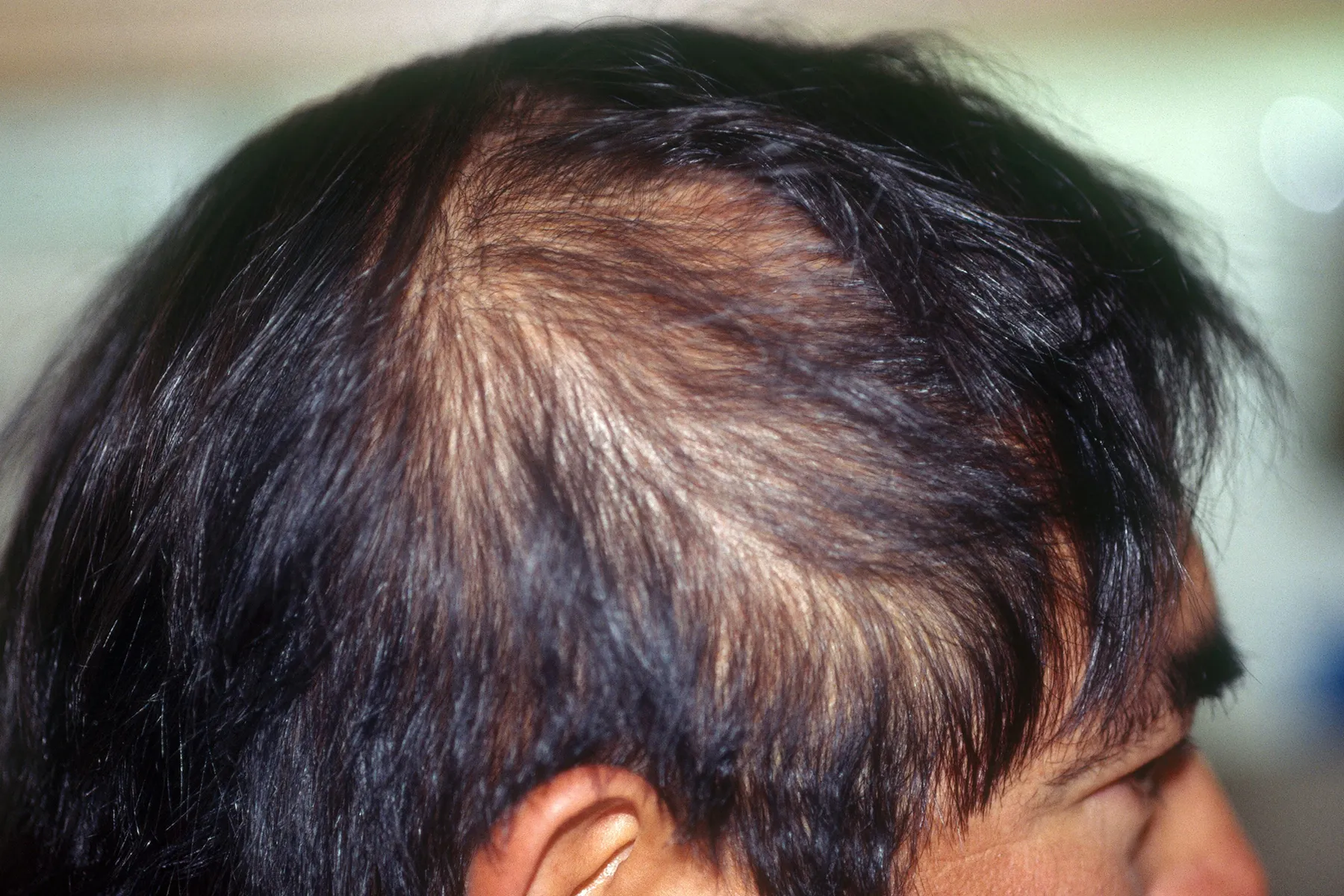 Why Am I Losing Body Hair?