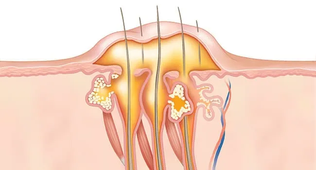 drawing a boil to a head