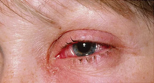 Purulent Conjunctivitis In Measles