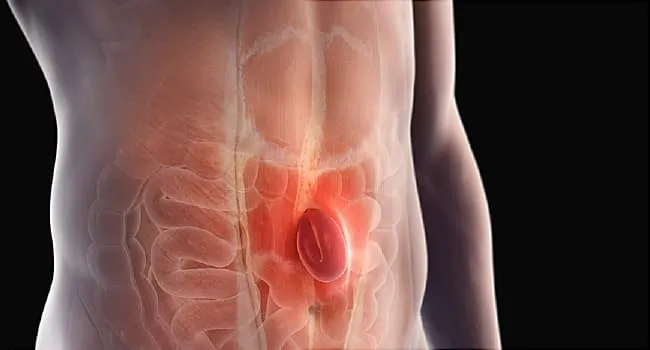 hernia examples pictures