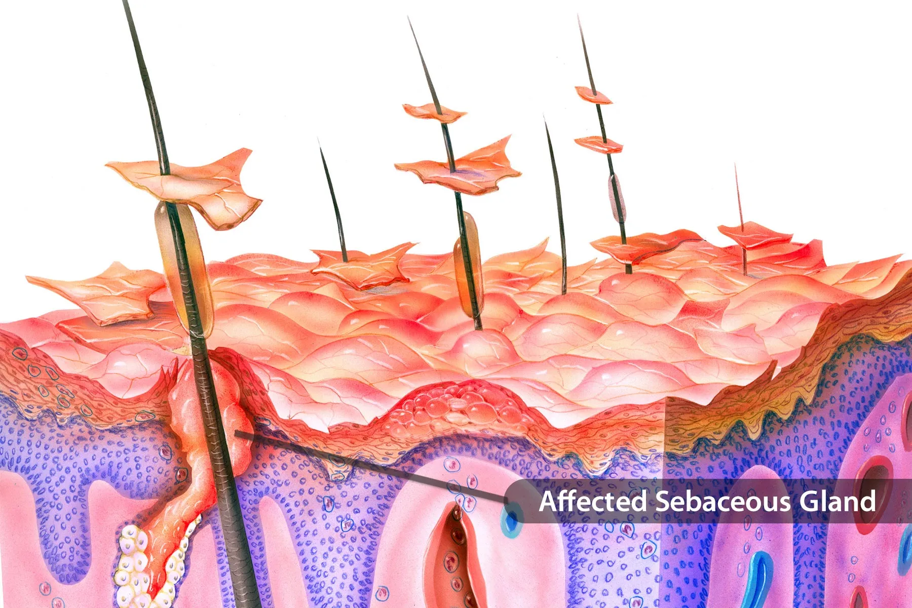 In Pictures: Guide to Seborrheic Dermatitis