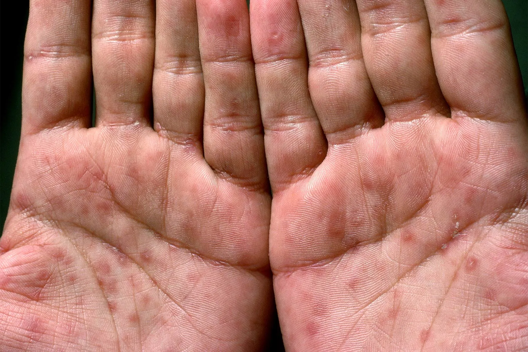 Hiv And Aids Rashes And Skin Conditions