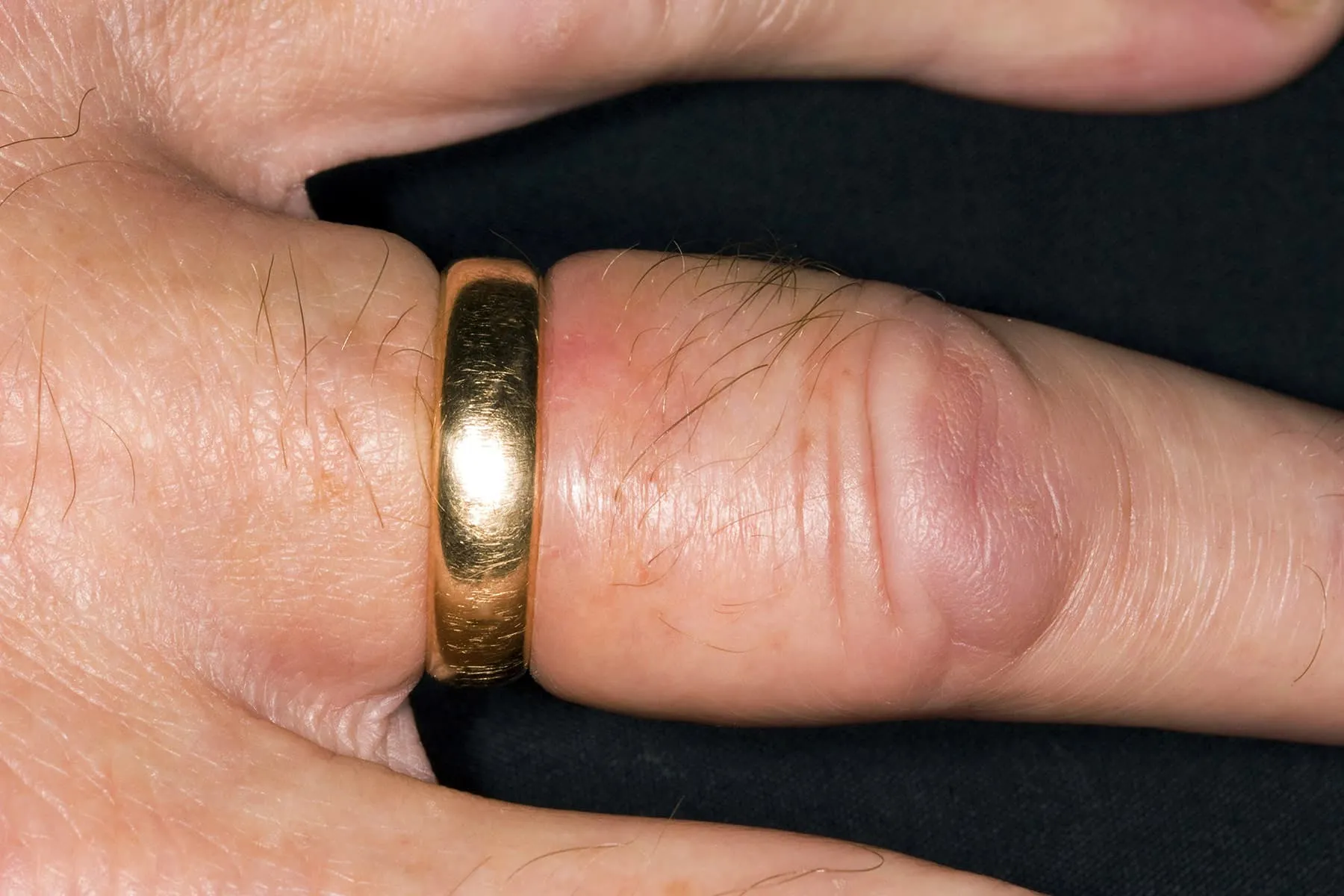 15 Causes of Swollen Fingers