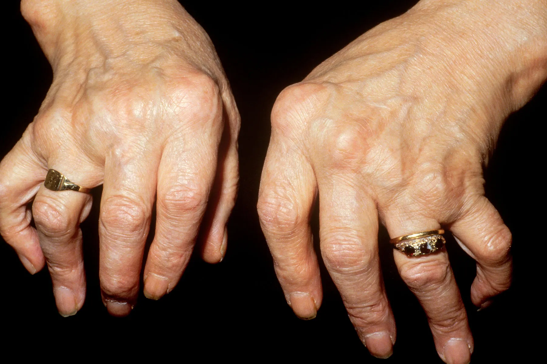 In Pictures: How RA Affects Different Parts of Your Body