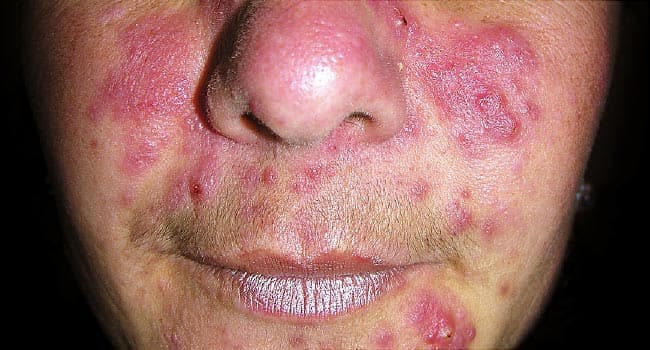 rosacea forehead texture