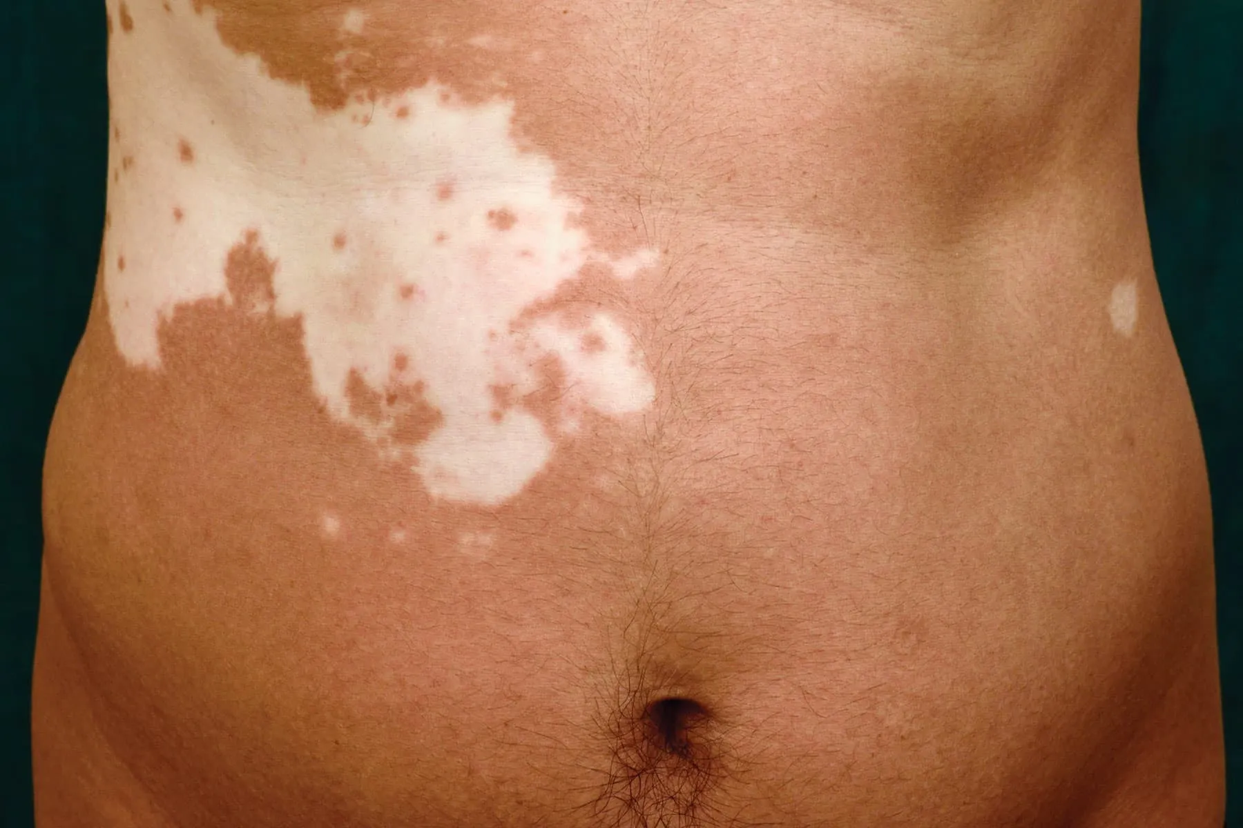 Skin Problems Linked to IBD
