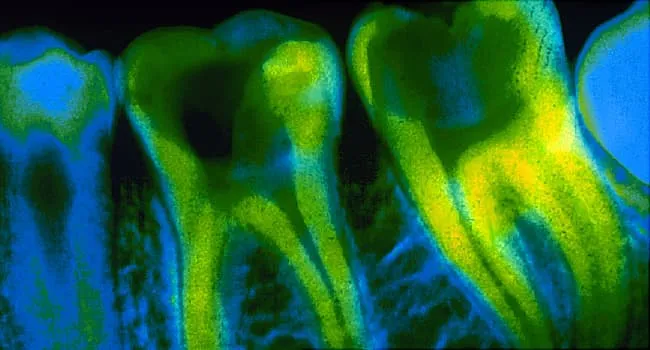 15 Common Dental Problems and Tooth Diseases