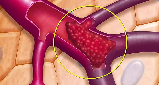 15 Types of Thrombosis Explained With Illustrations