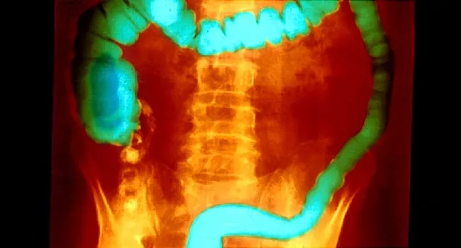 Ulcerative Colitis Pictures: Warning Signs of UC, How It's Different ...
