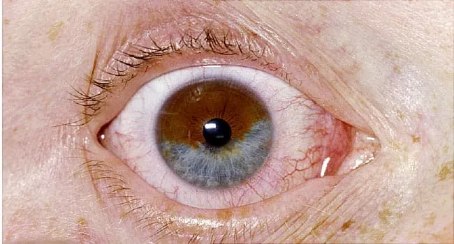 Pictures of Unusual Eye Conditions