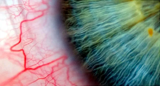 why do i keep getting uveitis