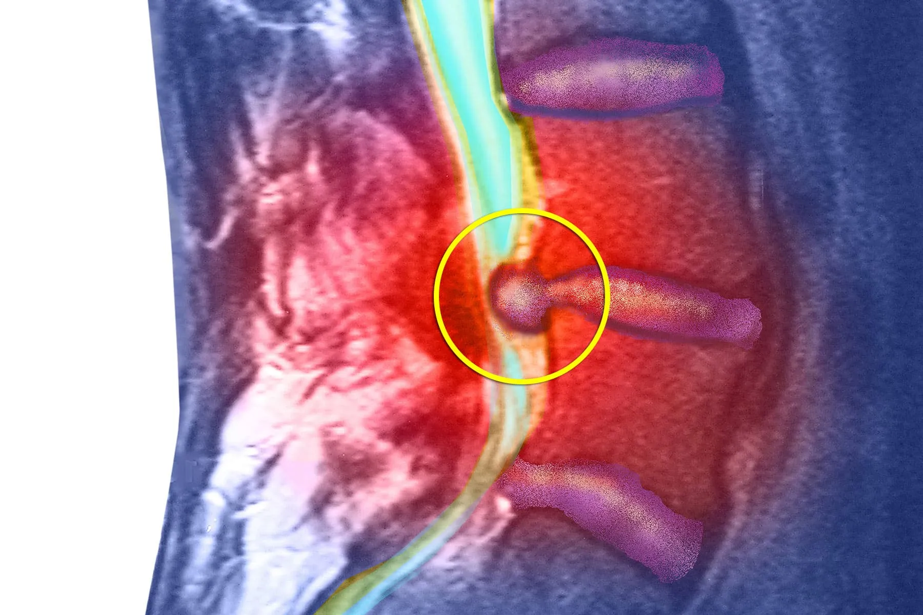 Visual Guide to Herniated Disks